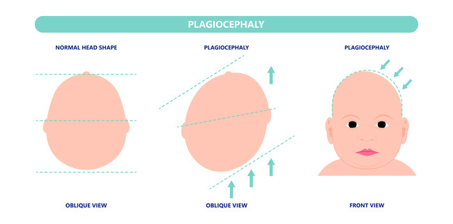 Plagiocephaly - Gejala, penyebab dan mengobati - Alodokter