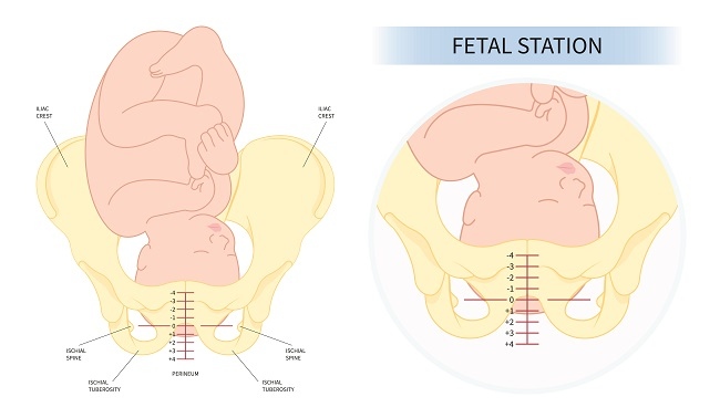 Distosia Bahu - Gejala, Penyebab, dan Pengobatan - Alodokter