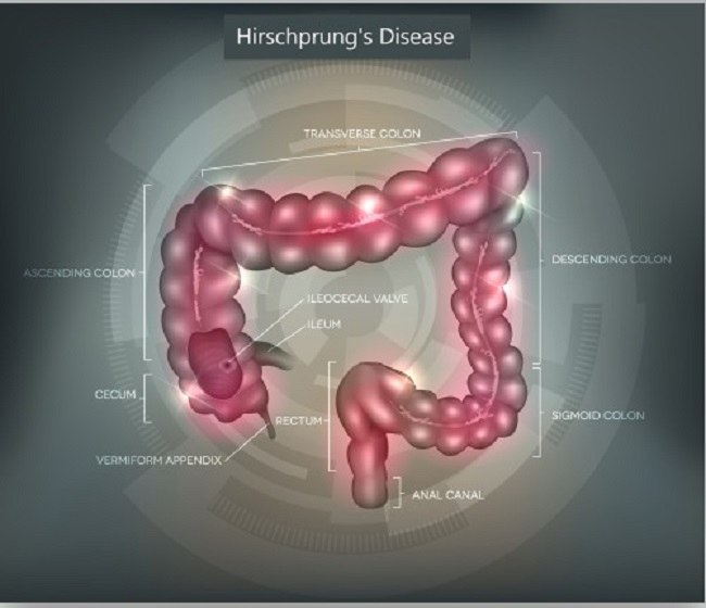 Hirschsprung Disease - patofisiologi, diagnosis, penatalaksanaan ...