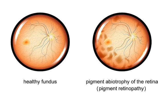 Prognosis Retinitis Pigmentosa - Alomedika