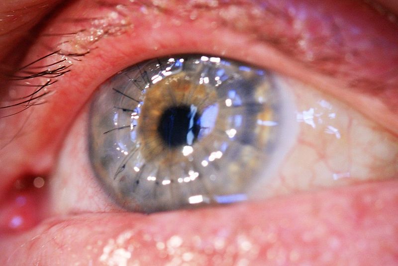 Transplantasi Kornea - teknik, indikasi, komplikasi, pedoman klinis ...