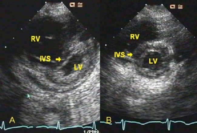 Diagnosis Cor Pulmonale - Alomedika