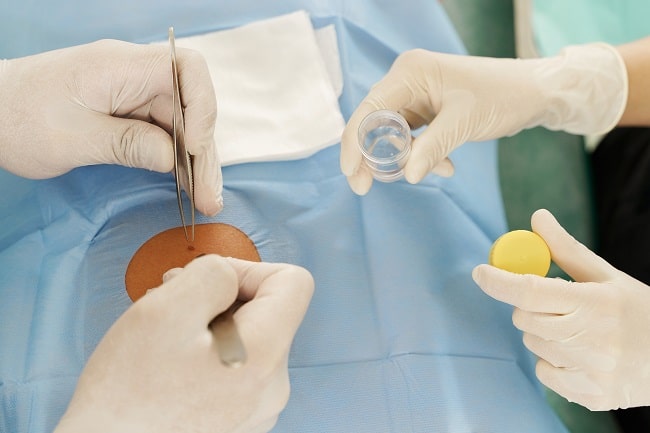 Hentikan Penggunaan Antibiotik Topikal Pasca Biopsi Kulit - Alomedika