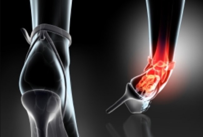 Patofisiologi Ankle Sprain - Alomedika