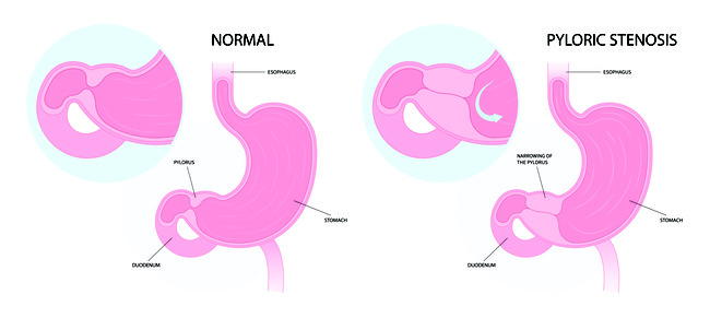 Stenosis Pilorus - Gejala, penyebab dan mengobati - Alodokter