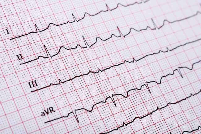 Memahami Gelombang P dalam EKG - Alomedika