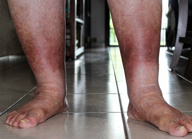 Red Legs: Membedakan Selulitis dari Penyebab Lain - Alomedika