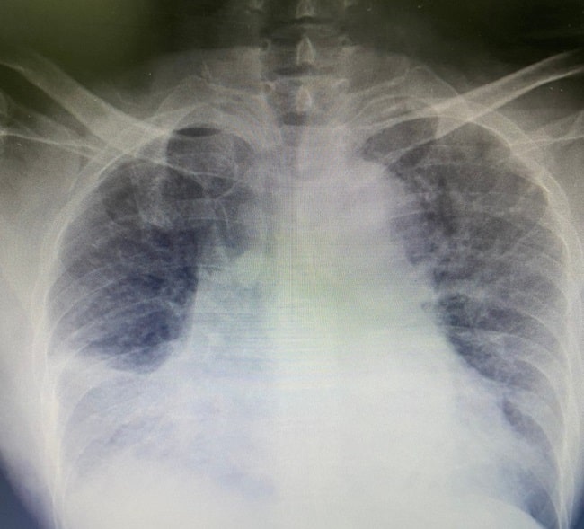 Pneumonia Aspirasi - patofisiologi, diagnosis, penatalaksanaan - Alomedika