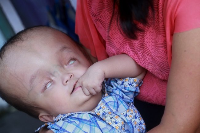 Hydrocephalus - patofisiologi, diagnosis, penatalaksanaan - Alomedika
