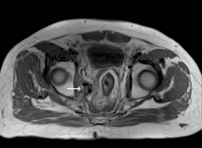Diagnosis Abses Perianal - Alomedika