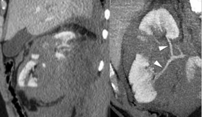 Ruptur Ginjal - patofisiologi, diagnosis, penatalaksanaan - Alomedika