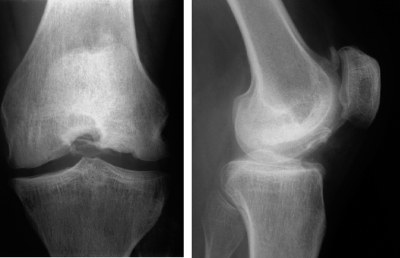 Osteoarthritis - patofisiologi, diagnosis, penatalaksanaan - Alomedika
