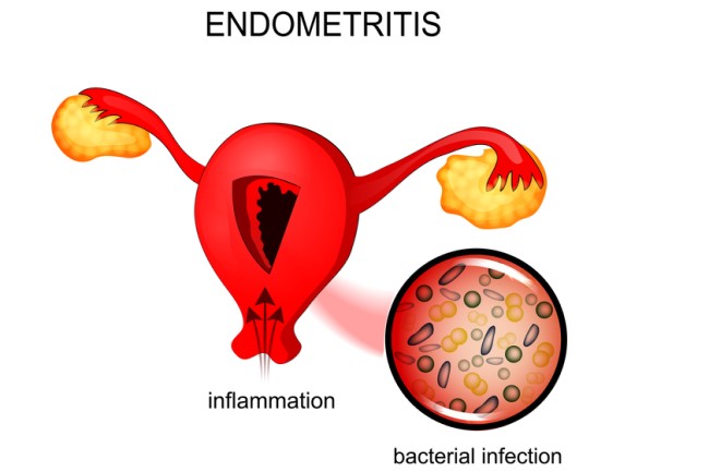 Endometritis - patofisiologi, diagnosis, penatalaksanaan - Alomedika