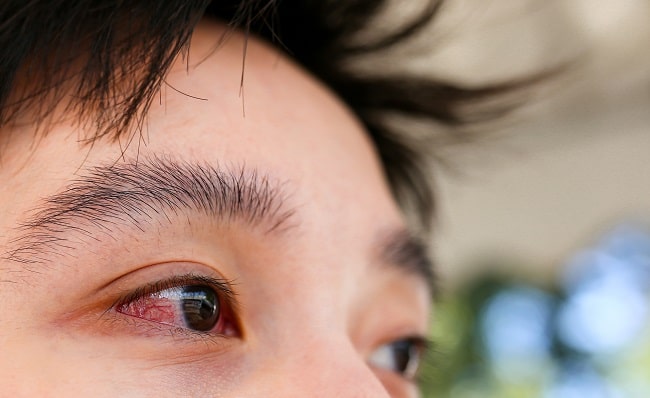 Patofisiologi Mata Merah - Alomedika