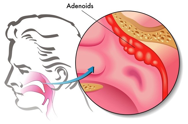 Hipertrofi Adenoid - patofisiologi, diagnosis, penatalaksanaan - Alomedika