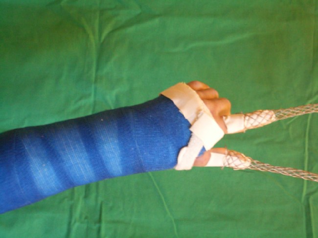 Edukasi Pasien Reduksi Tertutup Fraktur - Alomedika