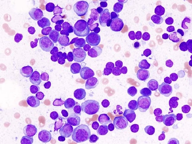 Diagnosis Multiple Myeloma - Alomedika