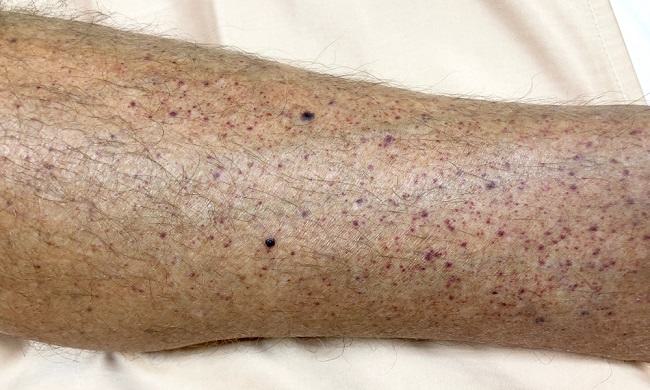 Diagnosis Immune Thrombocytopenic Purpura - Alomedika