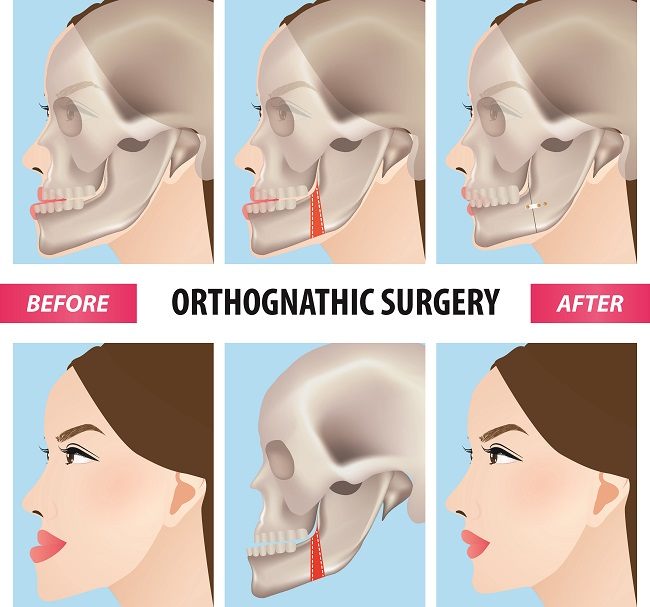 Operasi Rahang - Perumperindo.co.id