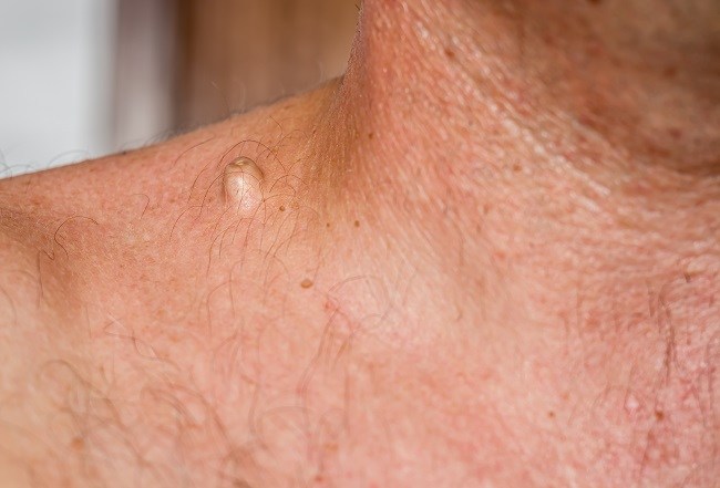 Kista Ateroma - Gejala, penyebab dan mengobati - Alodokter