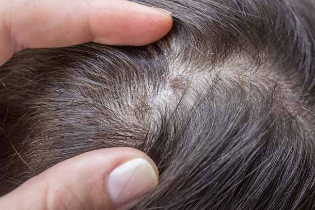 Kurap di Kepala, Kenali Penyebab dan Cara Penularannya - Alodokter