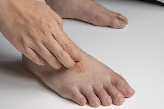 Ciri-Ciri Kurap yang Penting untuk Diketahui - Alodokter