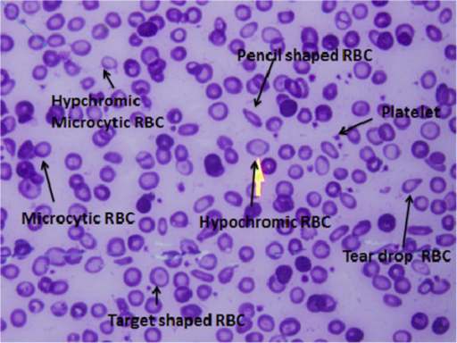 Etiologi Anemia Defisiensi Besi - Alomedika