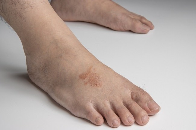 Kurap di Kaki, Kenali Gejala dan Cara Mengatasinya - Alodokter