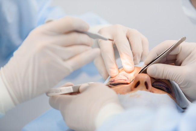 Mengenal tentang Operasi Kelopak Mata - Alodokter