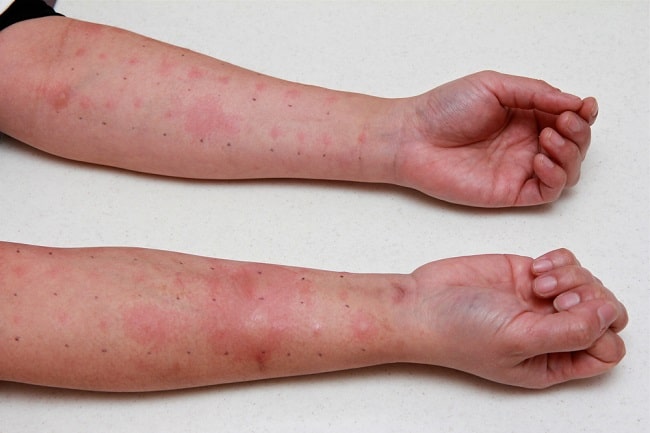 Teknik Skin Test - Alomedika