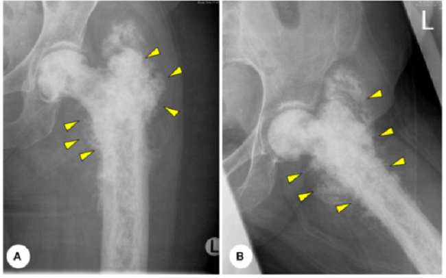 Penyakit Paget Tulang - patofisiologi, diagnosis, penatalaksanaan ...