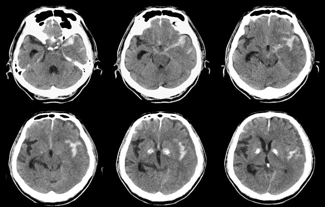 Diagnosis Perdarahan Subaraknoid Spontan - Alomedika