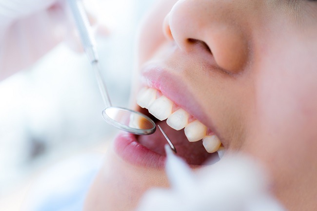 Ingin Melakukan Bonding Gigi? Cek Informasinya Dulu, Yuk! - Alodokter