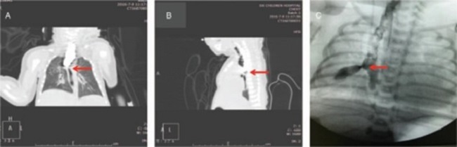Atresia Esofagus - patofisiologi, diagnosis, penatalaksanaan - Alomedika