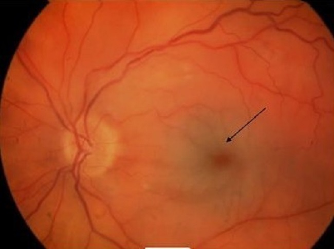 Oklusi Arteri Retina Sentral - patofisiologi, diagnosis ...