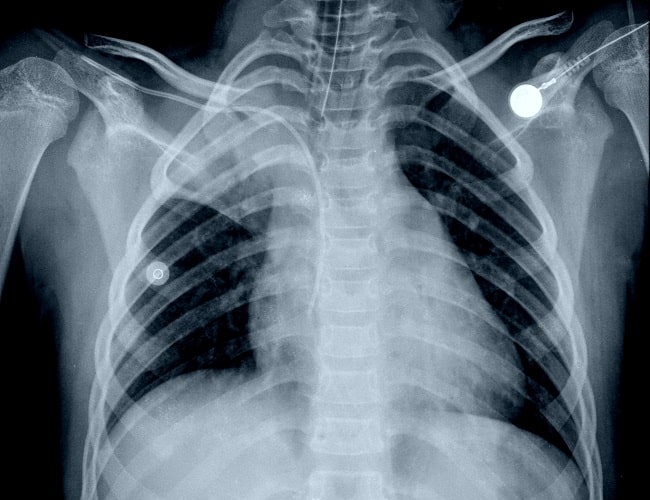 Diagnosis Atelektasis - Alomedika