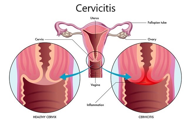 Servisitis - patofisiologi, diagnosis, penatalaksanaan - Alomedika