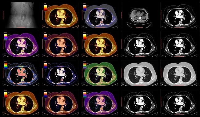 Teknik CT Scan Toraks - Alomedika