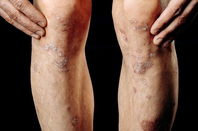 Kenali 5 Obat Kudis di Apotek - Alodokter