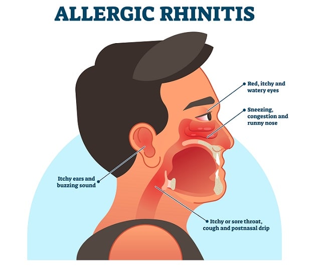 Diagnosis Rhinitis Alergi - Alomedika