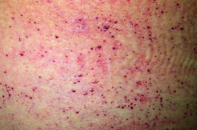 Penyakit Fabry - Gejala, Penyebab, dan Pengobatan - Alodokter