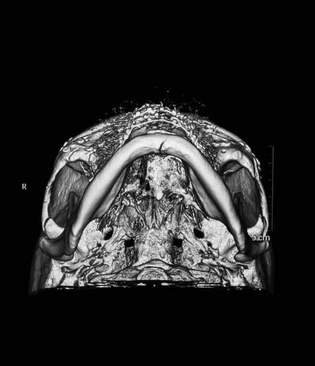 Manifestasi Klinis dan Pilihan Terapi pada Fraktur Basis Cranii - Alomedika