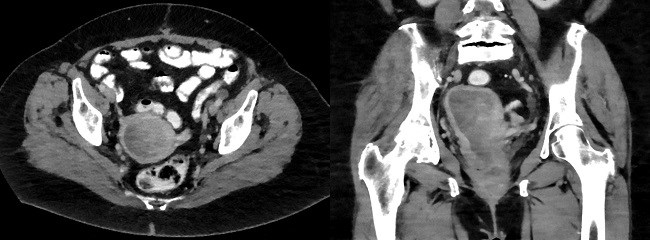 Leiomyosarcoma - patofisiologi, diagnosis, penatalaksanaan - Alomedika