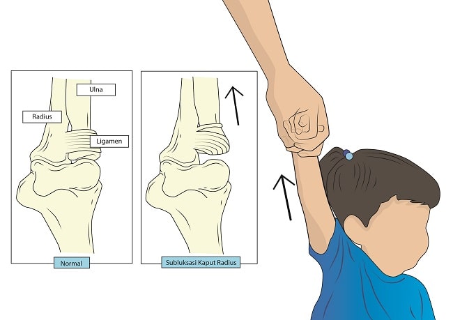 Subluksasi Kaput Radius - patofisiologi, diagnosis, penatalaksanaan ...