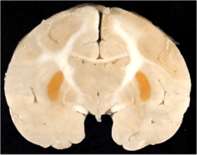 Kernikterus - patofisiologi, diagnosis, penatalaksanaan - Alomedika