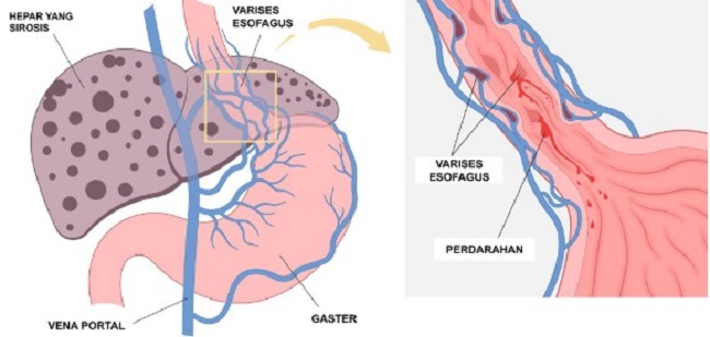 Varises Esofagus - patofisiologi, diagnosis, penatalaksanaan - Alomedika