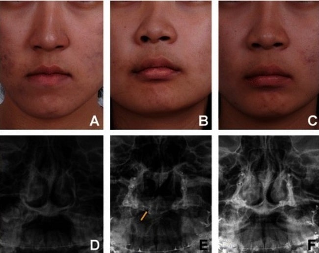 Etiologi Deviasi Septum Nasal - Alomedika