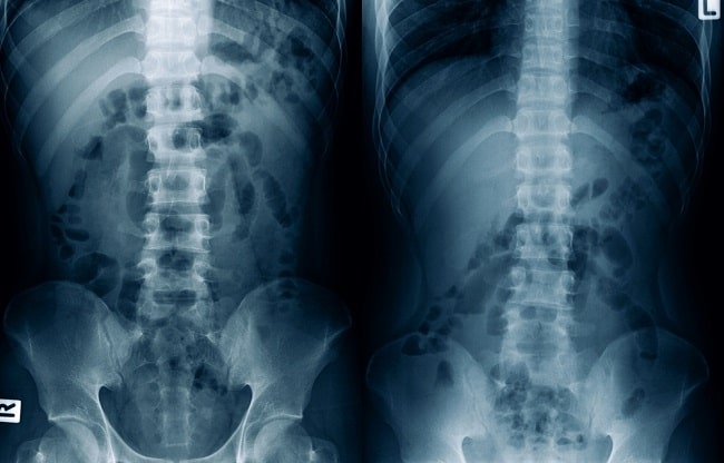 Teknik Foto Polos Abdomen - Alomedika