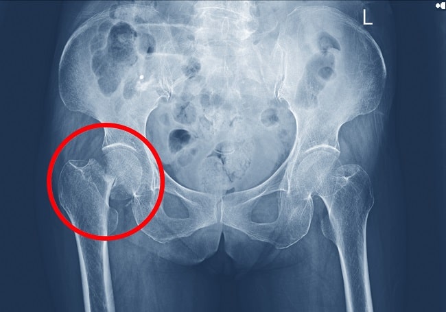 Manajemen Nyeri Fraktur Collum Femur – Blok Saraf Perifer vs Blok ...