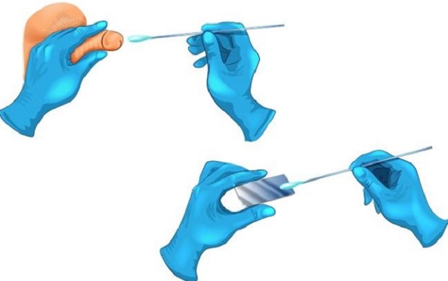 Indikasi Swab Uretra - Alomedika